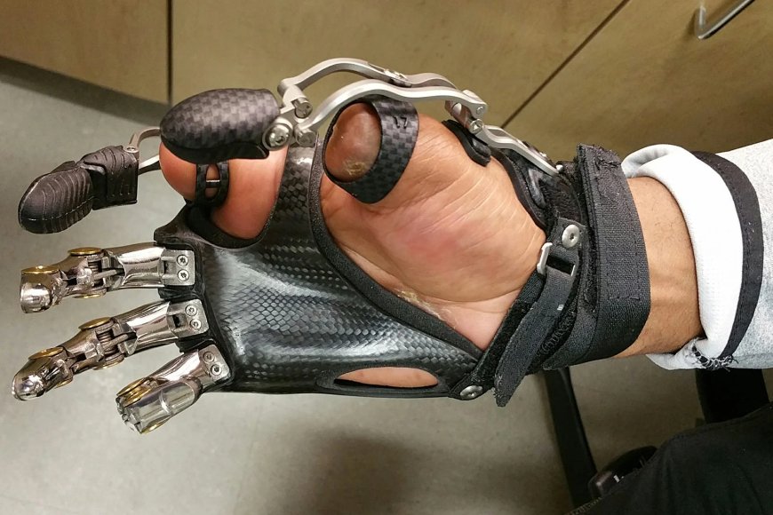 Understanding Prosthesis and Its Many Uses - The Hub Web